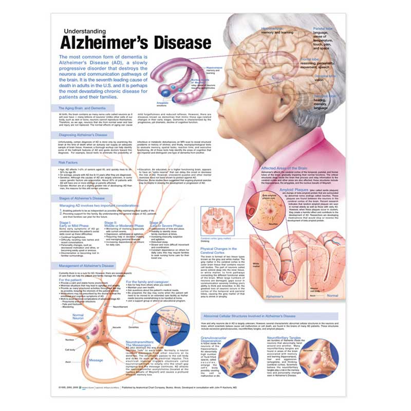Understanding Alzheimers Disease Anatomical Chart 2nd | Pro Therapy ...